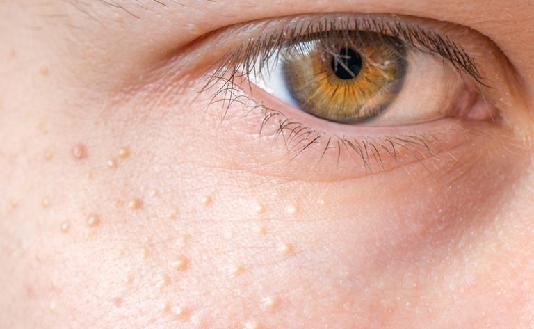 Milium na pele: o que é e como tratar de forma eficaz