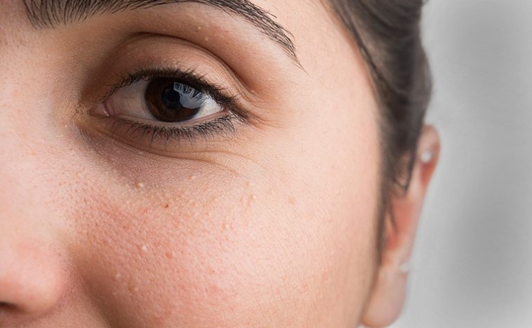 Milium na pele: o que é e como tratar de forma eficaz