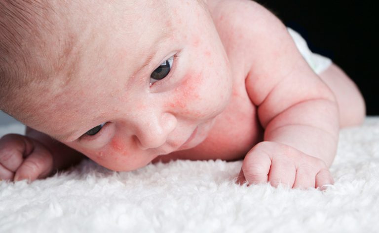 Milium na pele: o que é e como tratar de forma eficaz