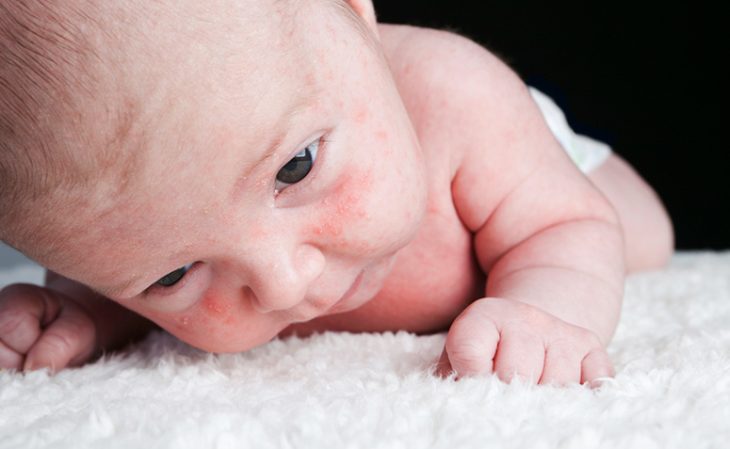 Brotoeja em bebês: veja as causas, saiba como tratar e prevenir