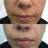 Bigode chinês: o que é, tratamentos e exercícios [ANTES E DEPOIS]