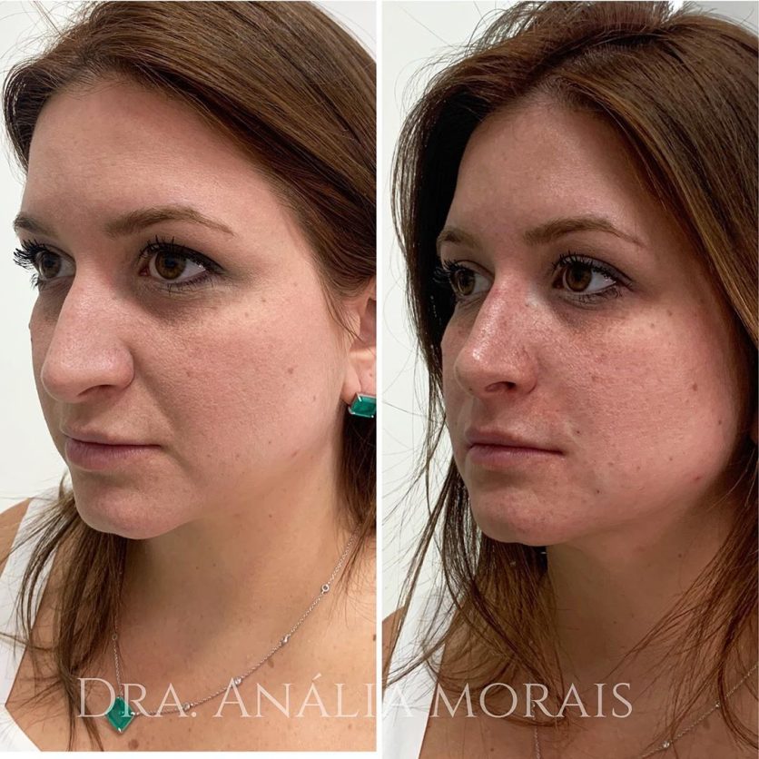 Bigode chinês: o que é, tratamentos e exercícios