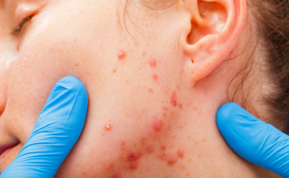 Tipos de acne: o que é, como identificar e tratamentos adequados