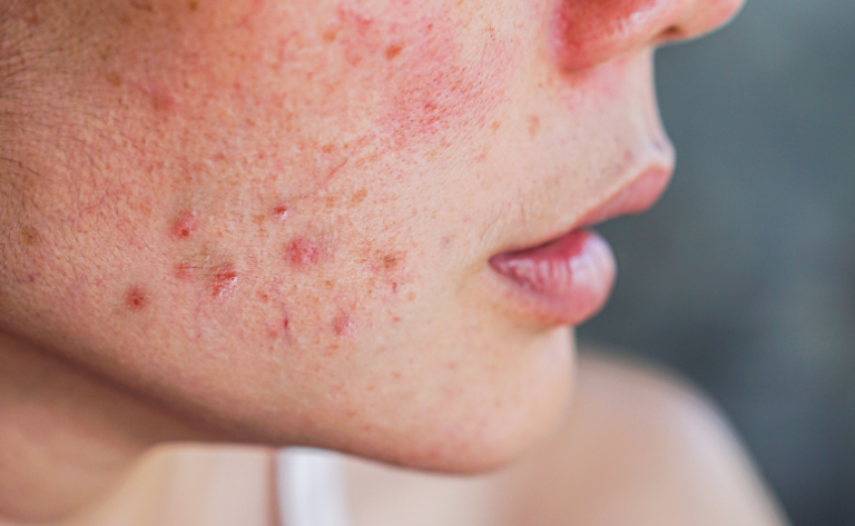 Tipos de acne: o que é, como identificar e tratamentos adequados