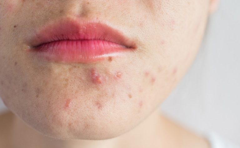 Dermatite perioral: o que é, sintomas, cuidados e dicas