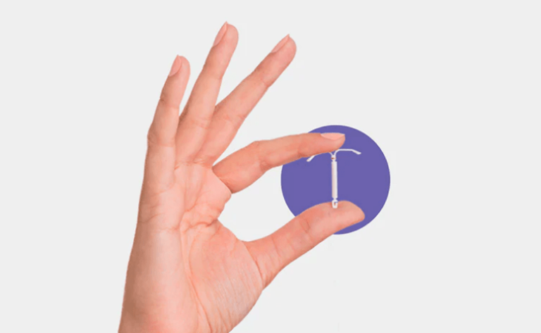 DIU Kyleena: como funciona, benefícios e contraindicações