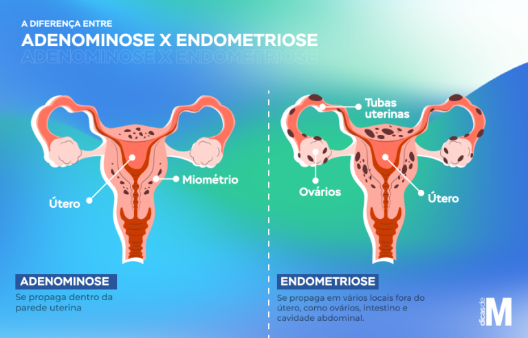 Adenomiose: o que é, causas e tratamentos