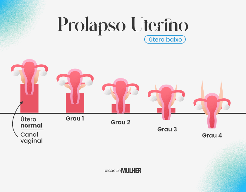 Prolapso uterino: causas e tratamentos para colo do útero baixo